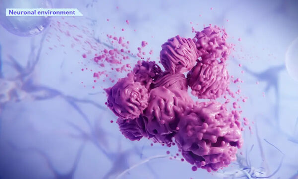 Alpheus Medical Lands $52M for Novel Brain Cancer Treatment | Twin ...